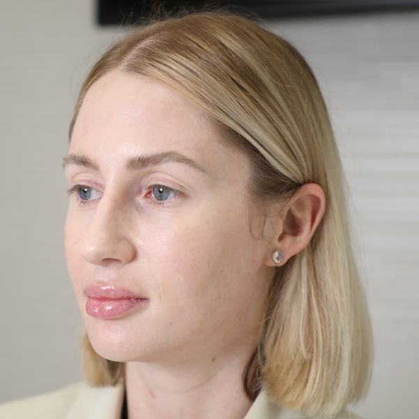 Thread Lift Dubai - Neck & Jaw Thread Lift
